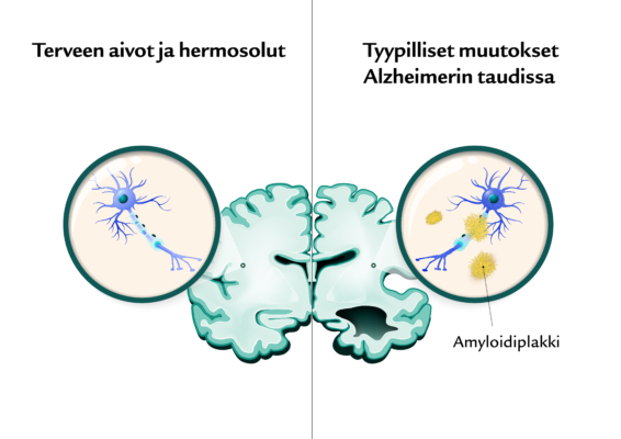 Alzheimerin tauti ja taudin ensioireet - Suomen Seniorihoiva